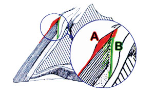 Dealing with Coronary Band Concerns