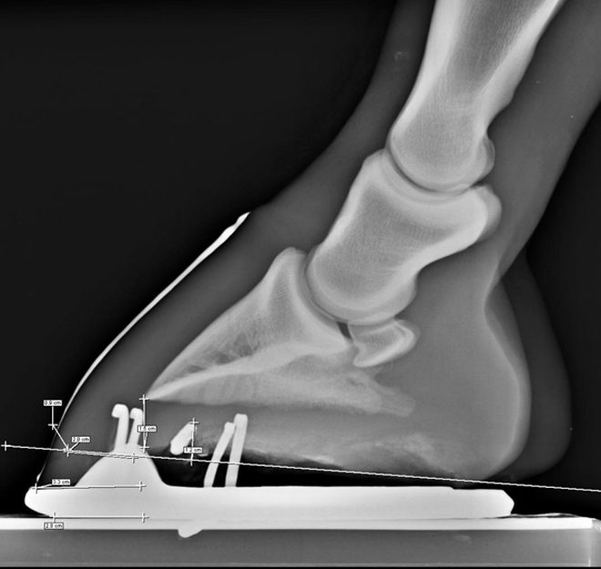 Considerations For Negative Plantar Angles