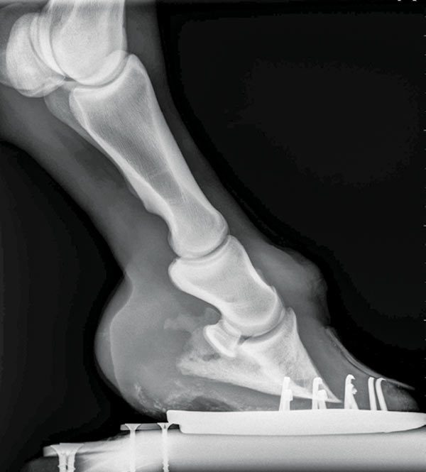 Club Foot or Upright Foot? It’s All About the Angles