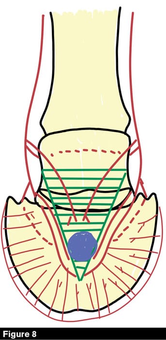 Applying the Heart-Bar Horseshoe